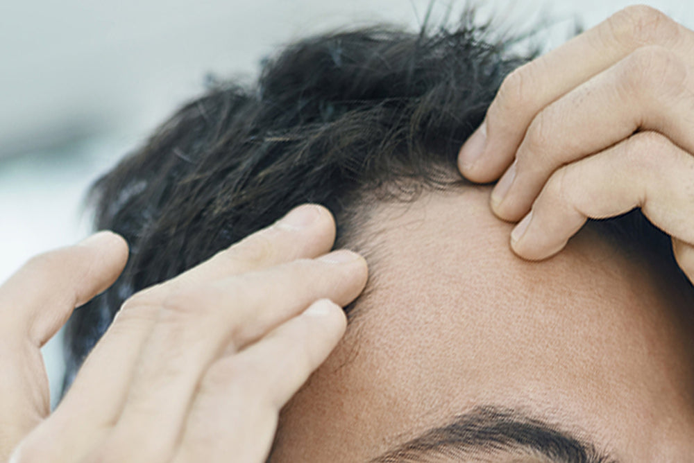 The signs and stages of hair loss - Honeyderm